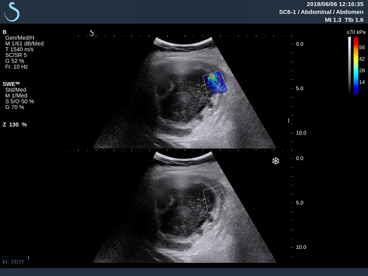 VIETNAMESE MEDIC ULTRASOUND: CASE 498: GALLBLADDER ABSCESS, Dr PHAN ...