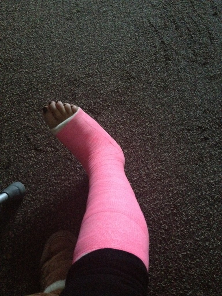 Casts and Toes: Some Short Leg Cast Pics