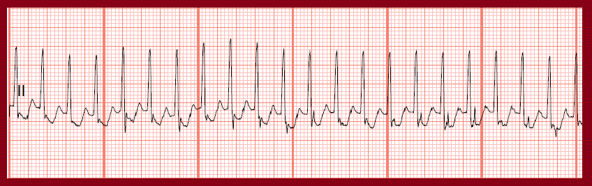 EKG Rhythm Strip Quiz 207
