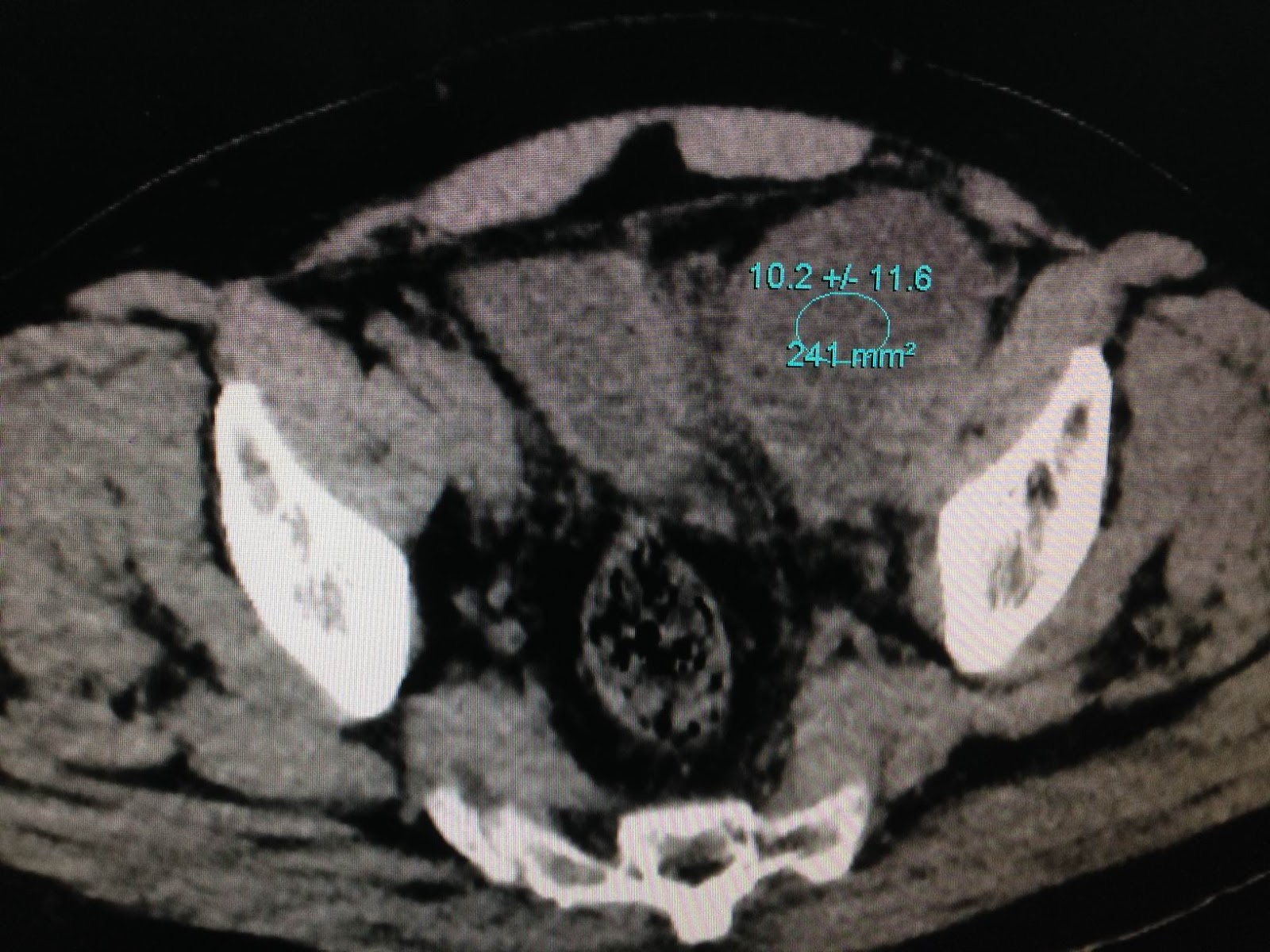 VIETNAMESE MEDIC ULTRASOUND: CASE 402 : DOUBLE URINARY BLADDER, Dr PHAN ...