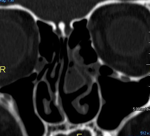 Mucocele and Pyocele of concha bullosa - Radiology Imaging