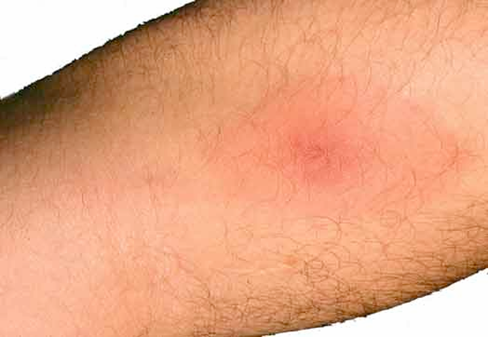 Global Environmental Health: Parasitic Diseases