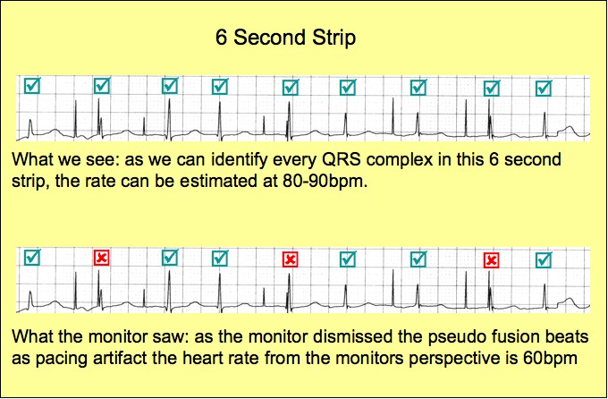 Cardiac Nurse: Teaching As I Learn: DDD pacing with psuedo fusion