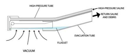Bit Tooth Energy: Waterjetting 17c - Discriminate cutting of tissue