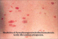 Medical Videos ppt and Lecture Notes: Thrombocytopenia - Low platelet Count