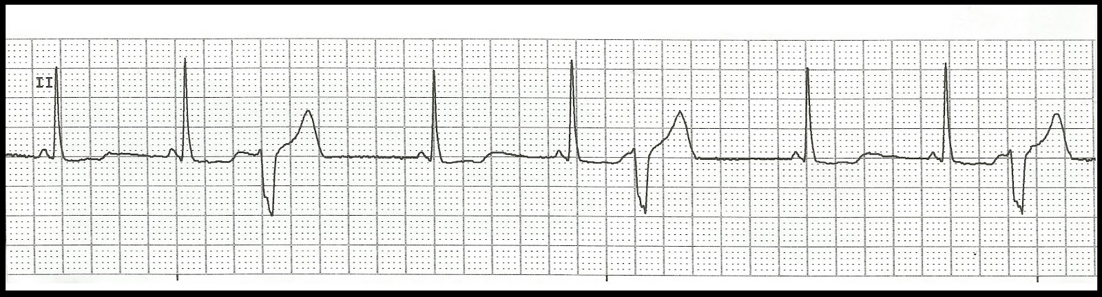 Practice EKG Rhythm Strips 151