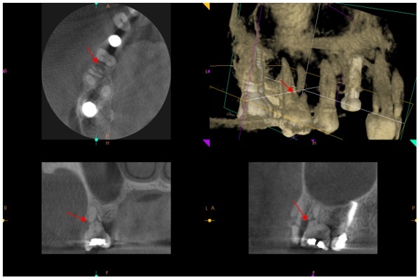 CBCT Scan: Root Fracture Case Study
