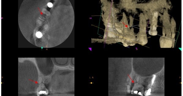 CBCT Scan: Root Fracture Case Study