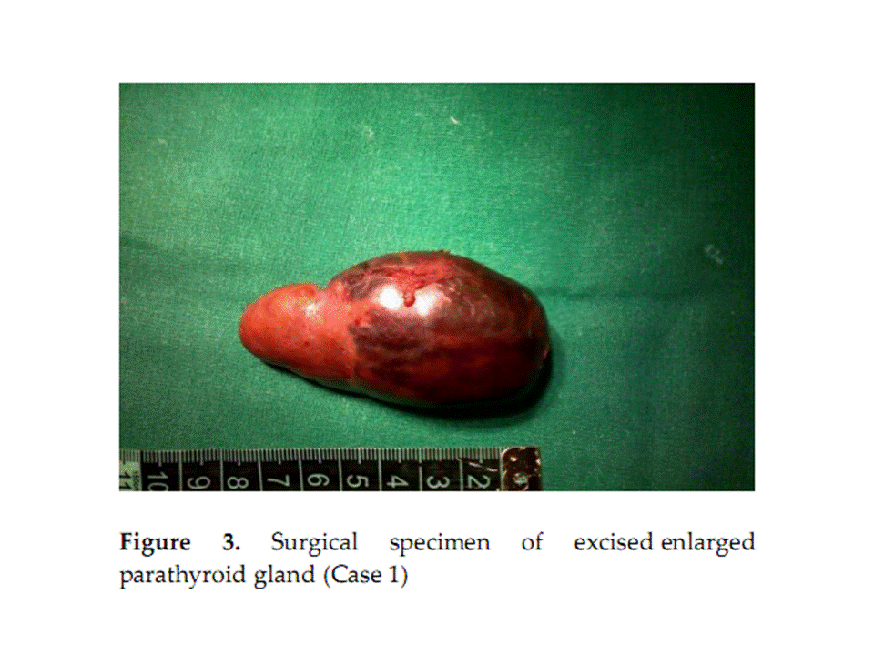 BÀI SOẠN VỀ SIÊU ÂM CHẨN ĐOÁN: CYSTIC PARATHYROID ADENOMA