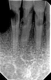 INTERPRETACIÓN RADIOGRÁFICA DE LA CARIES DENTAL