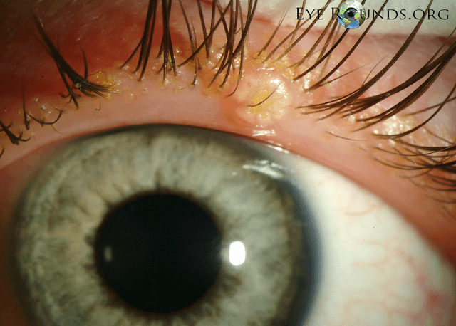 There s A Bump On My Eyelid Molluscum Contagiosum Eyedolatry there-s-a-bump-on-my-eyelid-molluscum-contagiosum-eyedolatry
