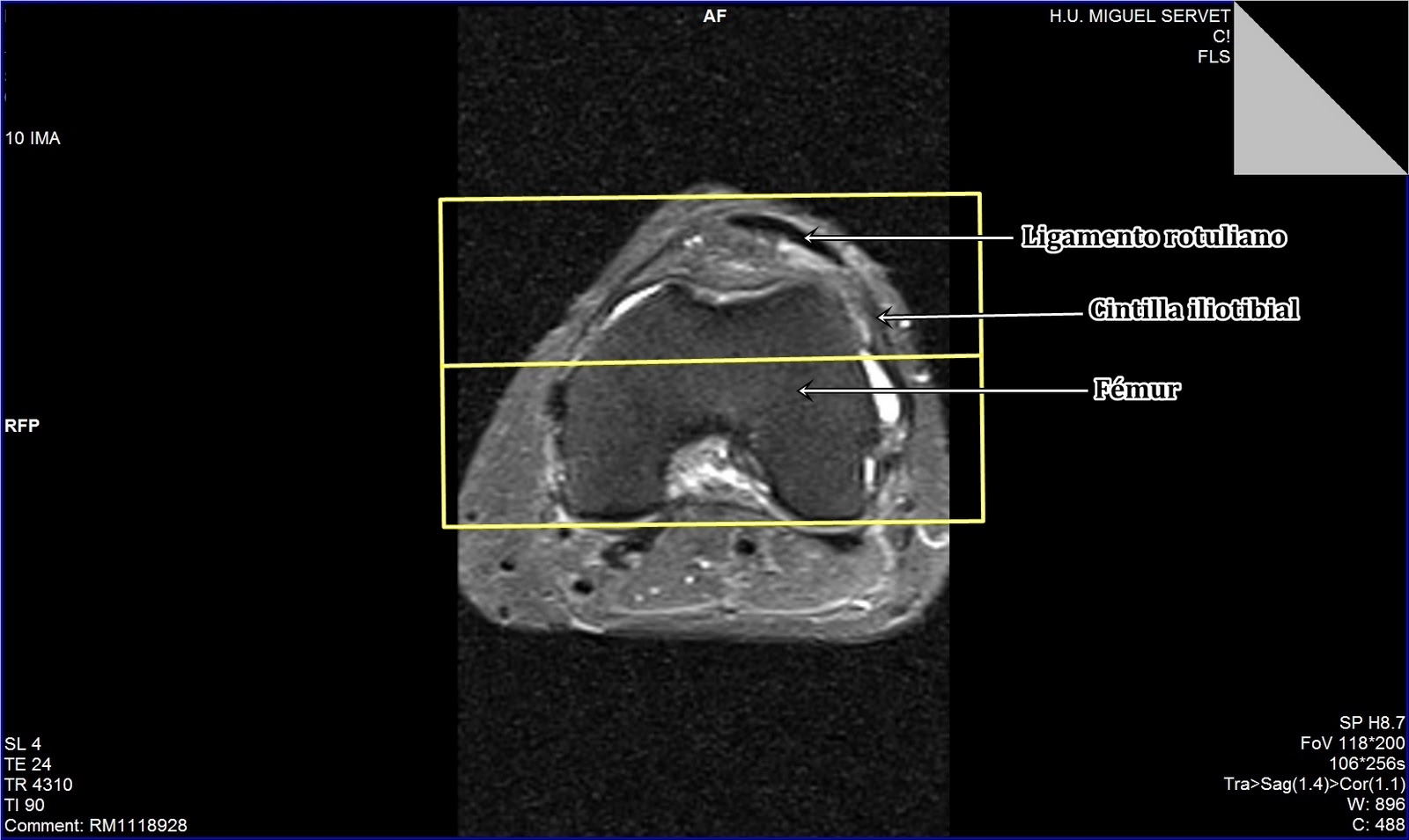 Protocolo de Rodilla por RM