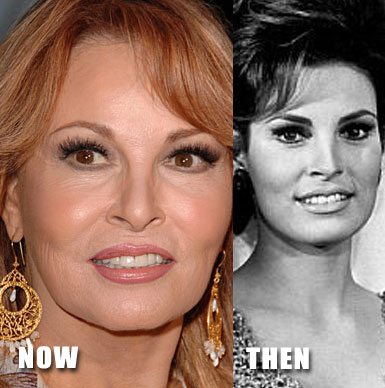Raquel Welch Plastic Surgery