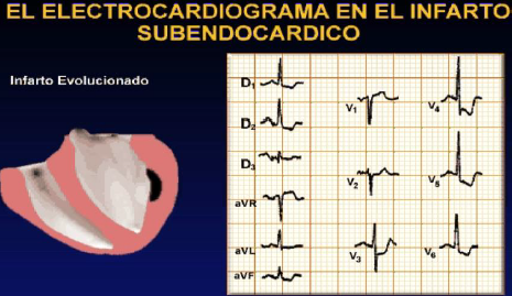 Electrocardiograma infarto subendocardico evolucionado