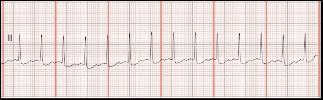 EKG Rhythm Strip Quiz 135