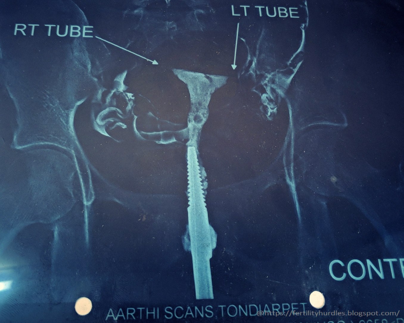 Fertility Solutions: Hysterosalpingogram