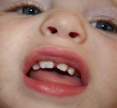 Dentistry lectures for MFDS/MJDF/NBDE/ORE: Dental Anomalies at ...