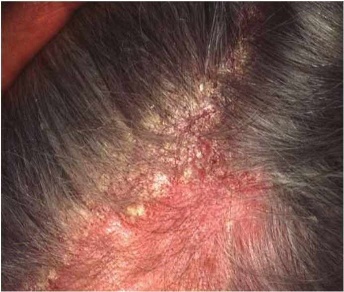 Berbagi Informasi Kedokteran: Dermatitis Seboroik