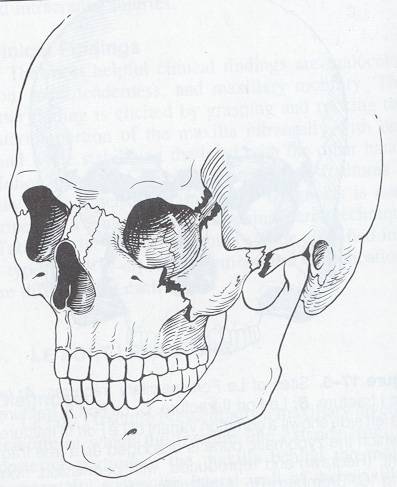 Zygoma Tripod Fractures ~ Welcome To Dental lecture Class