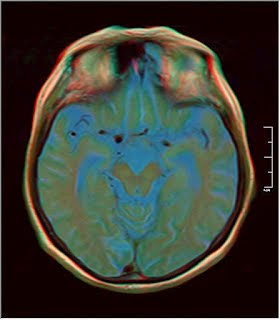 Nevit's blog: False-color Brain MRI (Motion artifacts)