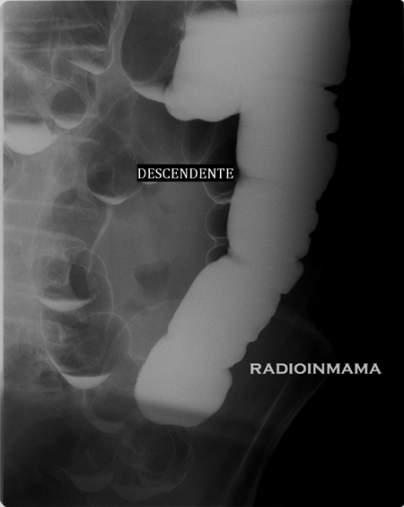 Flanco Esquerdo : Radiologia do cólon descendente