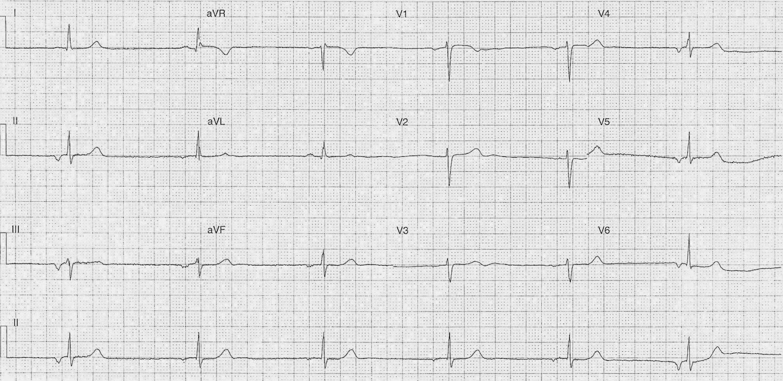 ECG of the Week: ECG of the Week - 21st January 2013 - Interpretation