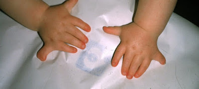 Polidactilia - Causas e Tratamentos - Como Cuidar dos Pés