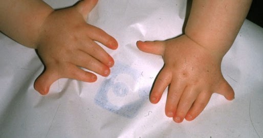 Polidactilia - Causas e Tratamentos - Como Cuidar dos Pés