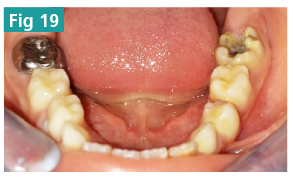 Molar Incisor Hypomineralization (MIH): Conservative Treatment Approach