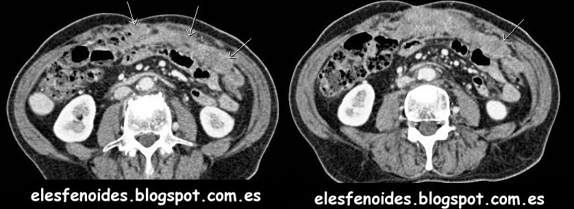 El esfenoides: Omental Cake-patsel omental. 2 imágenes 1 caso.