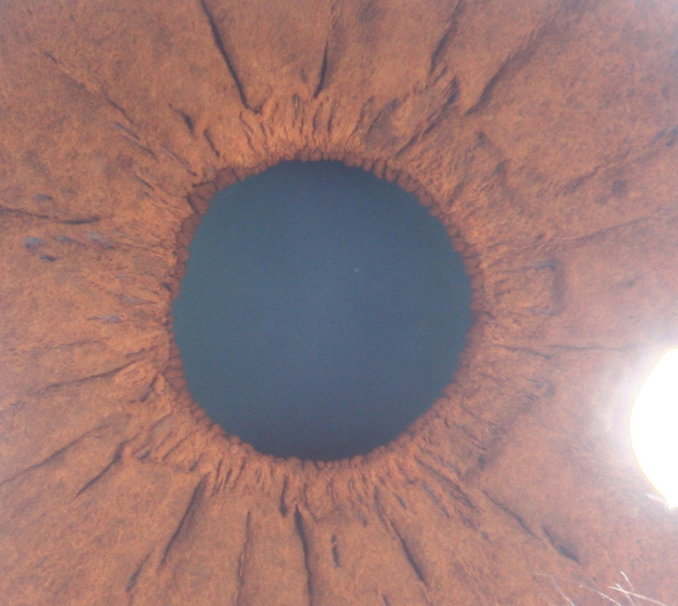 Modern & Multidimensional Iridology: IPB Structure, Pupil Flattening ...