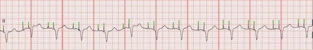 EKG Rhythm Strip Quiz 21