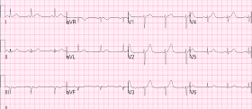 Dr. Smith's ECG Blog: A Tough ECG, But Learn From It!
