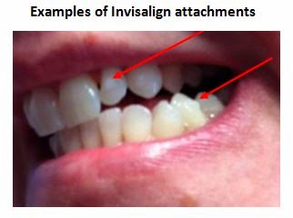 My Invisalign Chronicles: Week 3 - Attachments and New Trays
