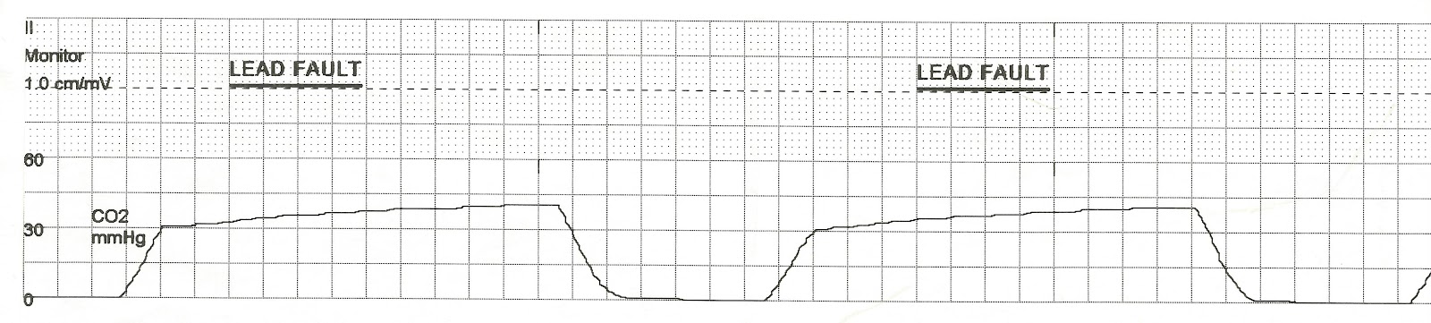 Float Nurse: Continuous Waveform Capnography