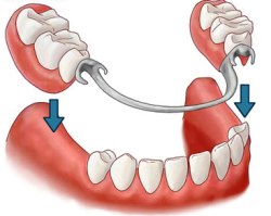 DentistaX: Prótese Parcial Removivel (PPR): Conceitos, objetivos ...