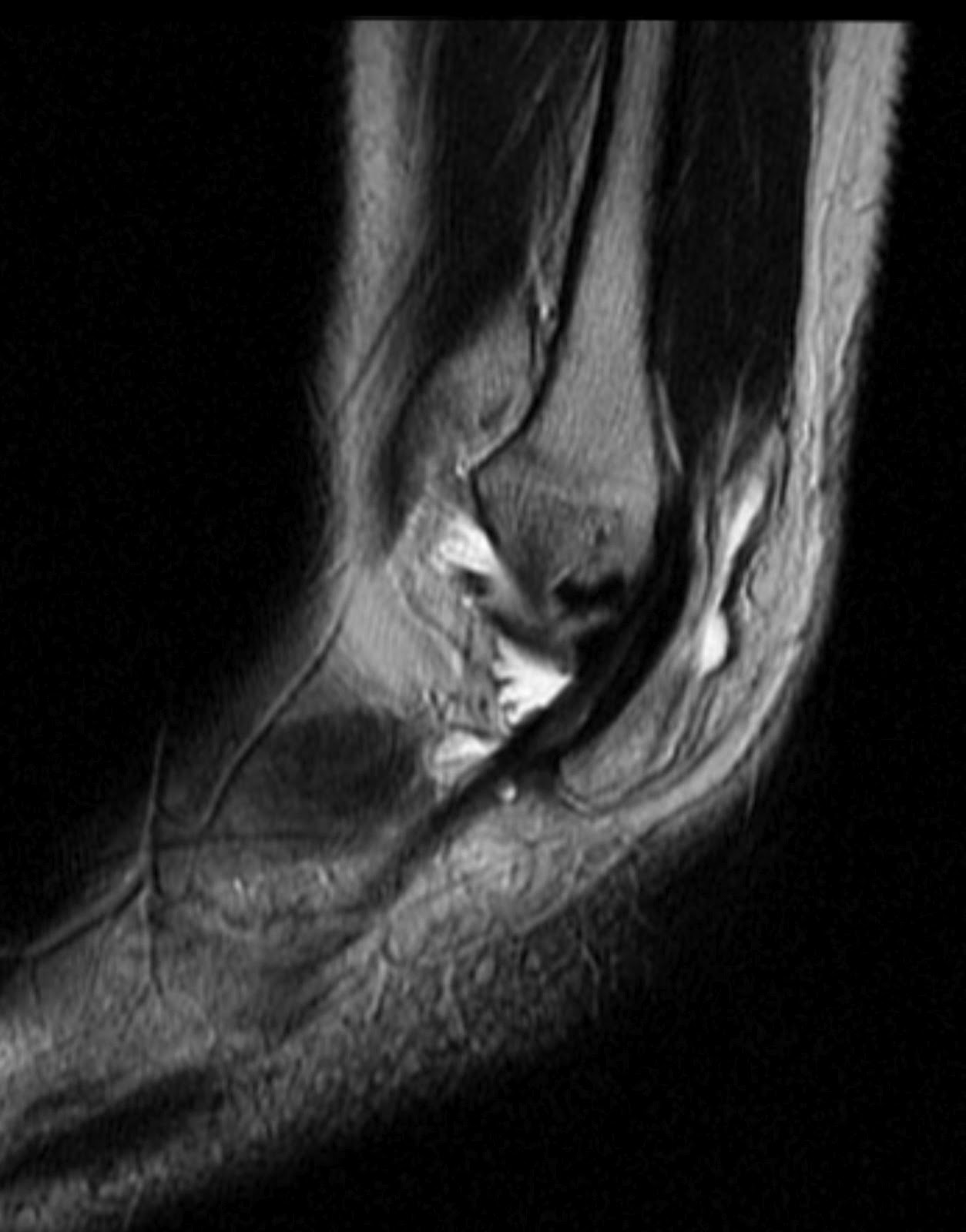 Split Peroneus Brevis Tendon-MRI - Sumer's Radiology Blog