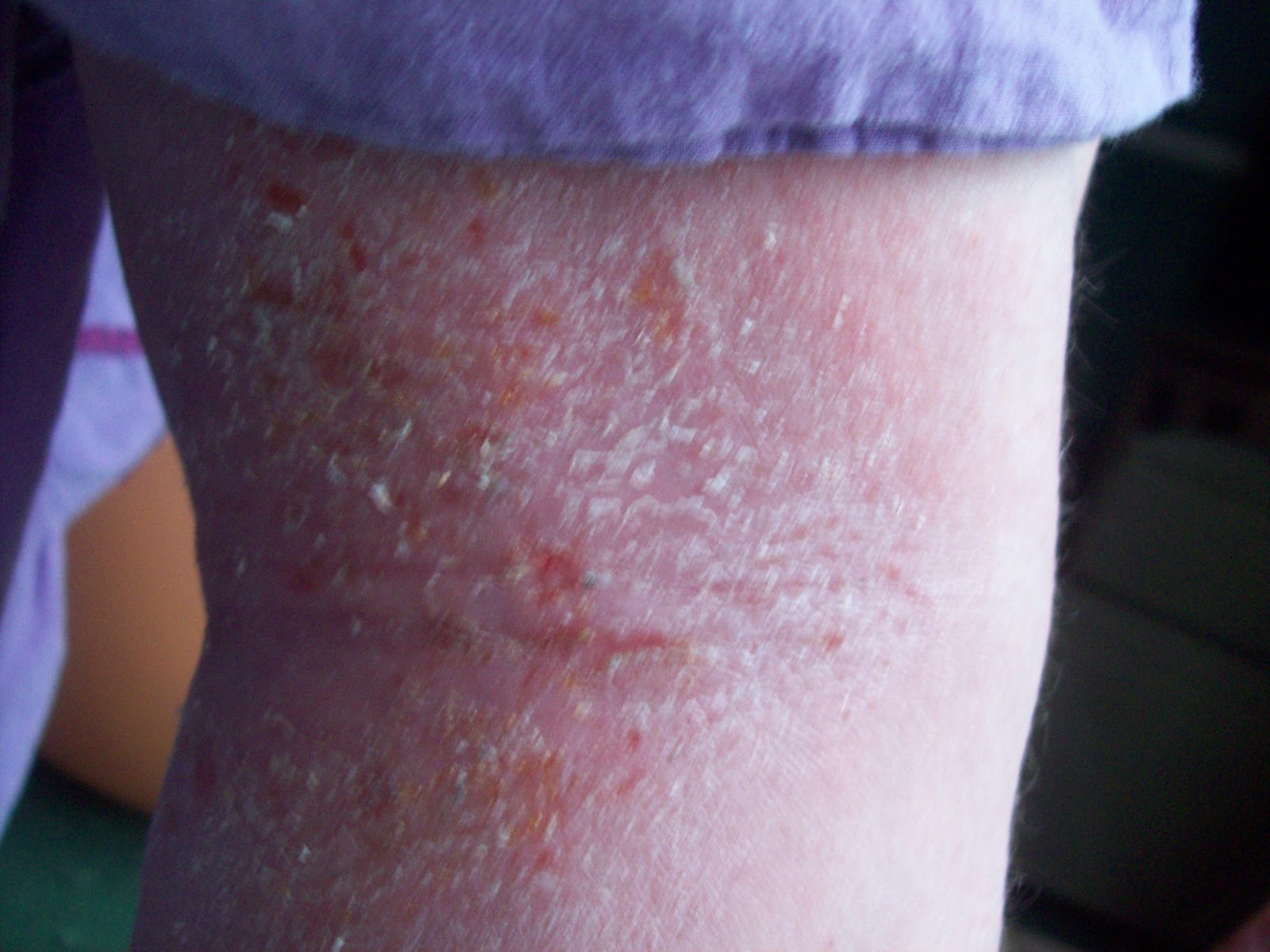 Topical Steroid Withdrawal: Day 148 (photos)