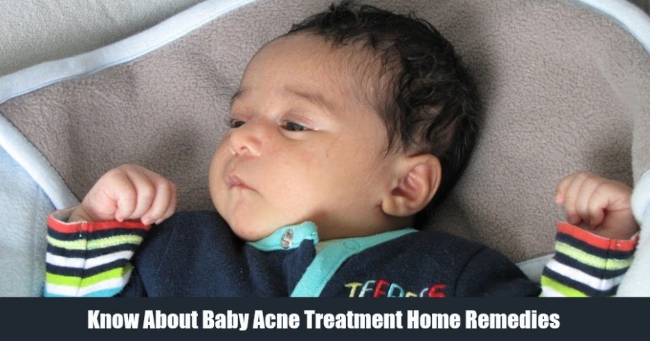 Know About Baby Acne Treatment Home Remedies - World Informs