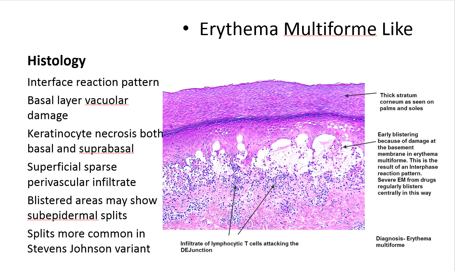 Dermatopathology Made Simple - Inflammatory: Interface - Vacuolar ...