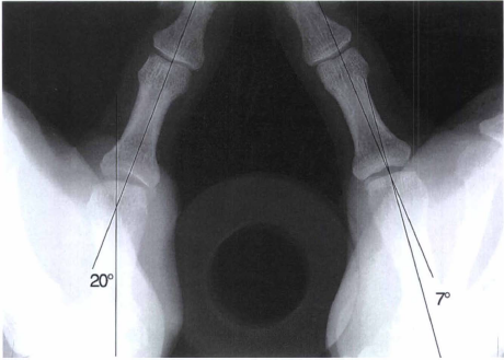PA STRESS "SKIER'S THUMB" PROJECTION - RadTechOnDuty