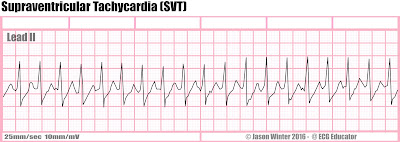 ECG Educator Blog : Six Second ECG Rhythm Strips