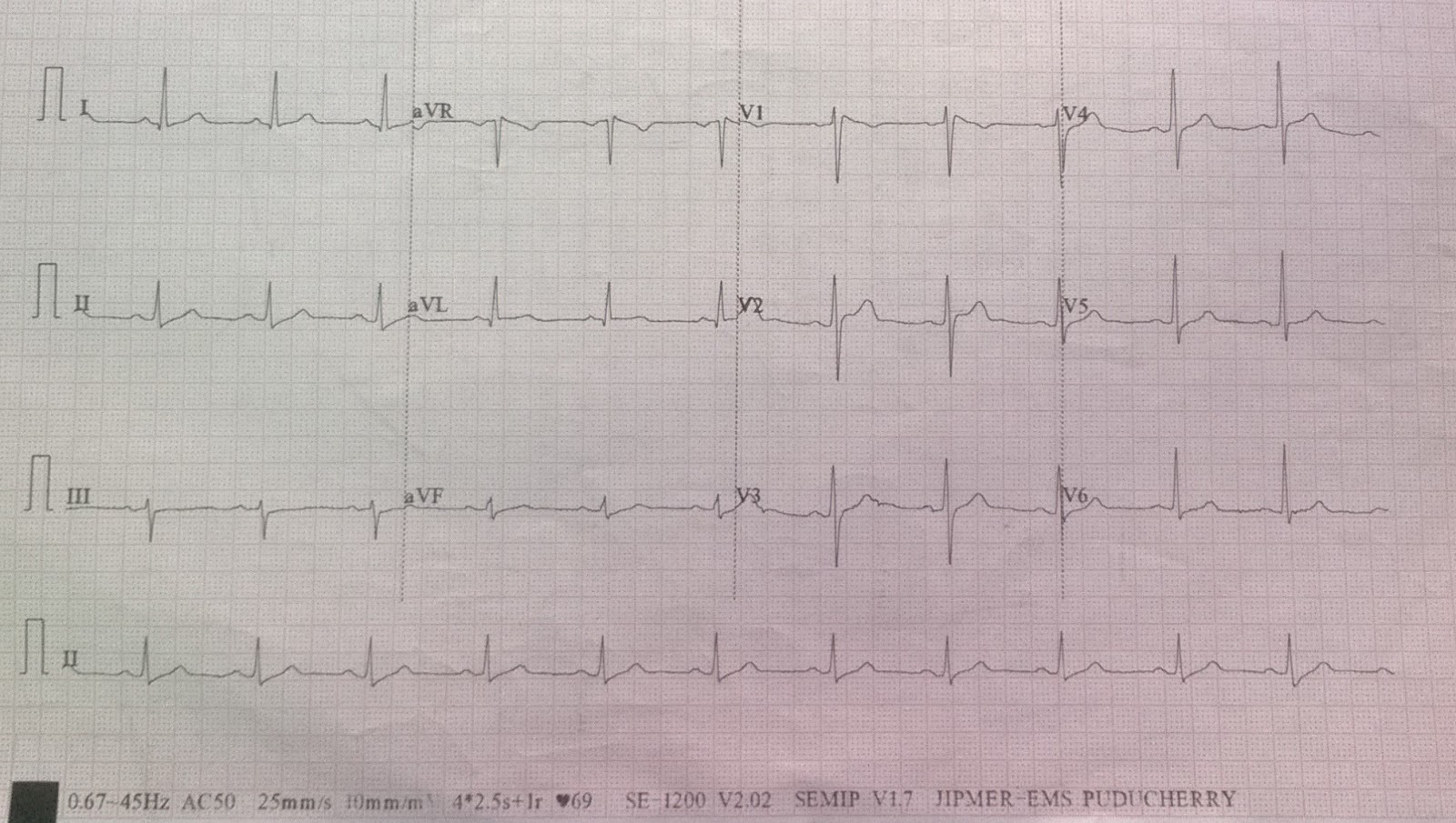 Cardiology window: Brugada ECG