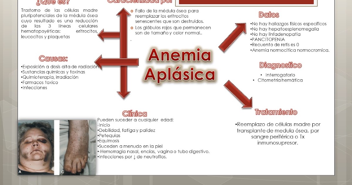 hematología : anemia por deficiencia de eritrocitos - anemia aplásica