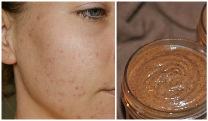 Get Rid Of Pimples Fast With This Simple Remedy | Healthy Central Blog