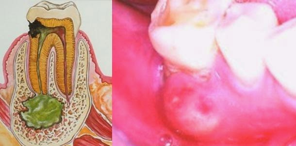 Tudo Sobre Doenças e Prevenções Bucais.: maio 2014