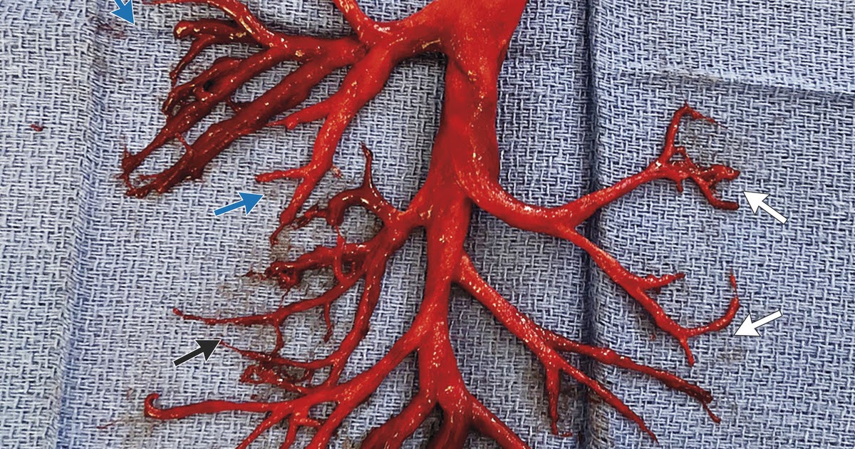 TYWKIWDBI ("Tai-Wiki-Widbee"): Awesome bronchial cast