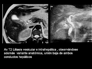 COLANGIO RM: COLANGIO RM