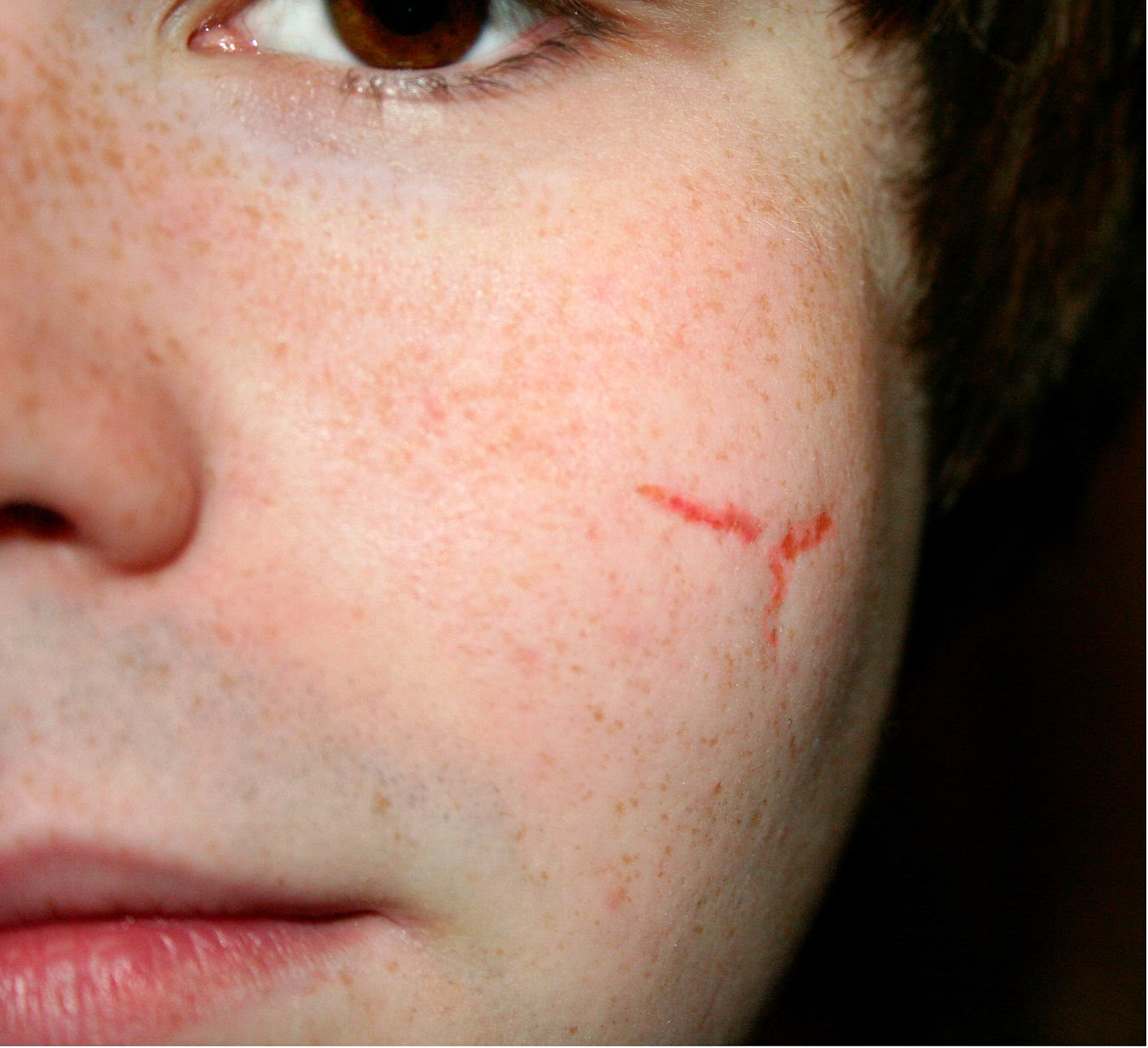 Restylane Skin Booster | Breast Enlargement Malaysia | Fat Derived Stem ...