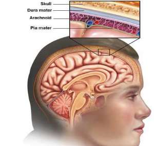 Meningite - Causas e sintomas de meningite: O que é meningite